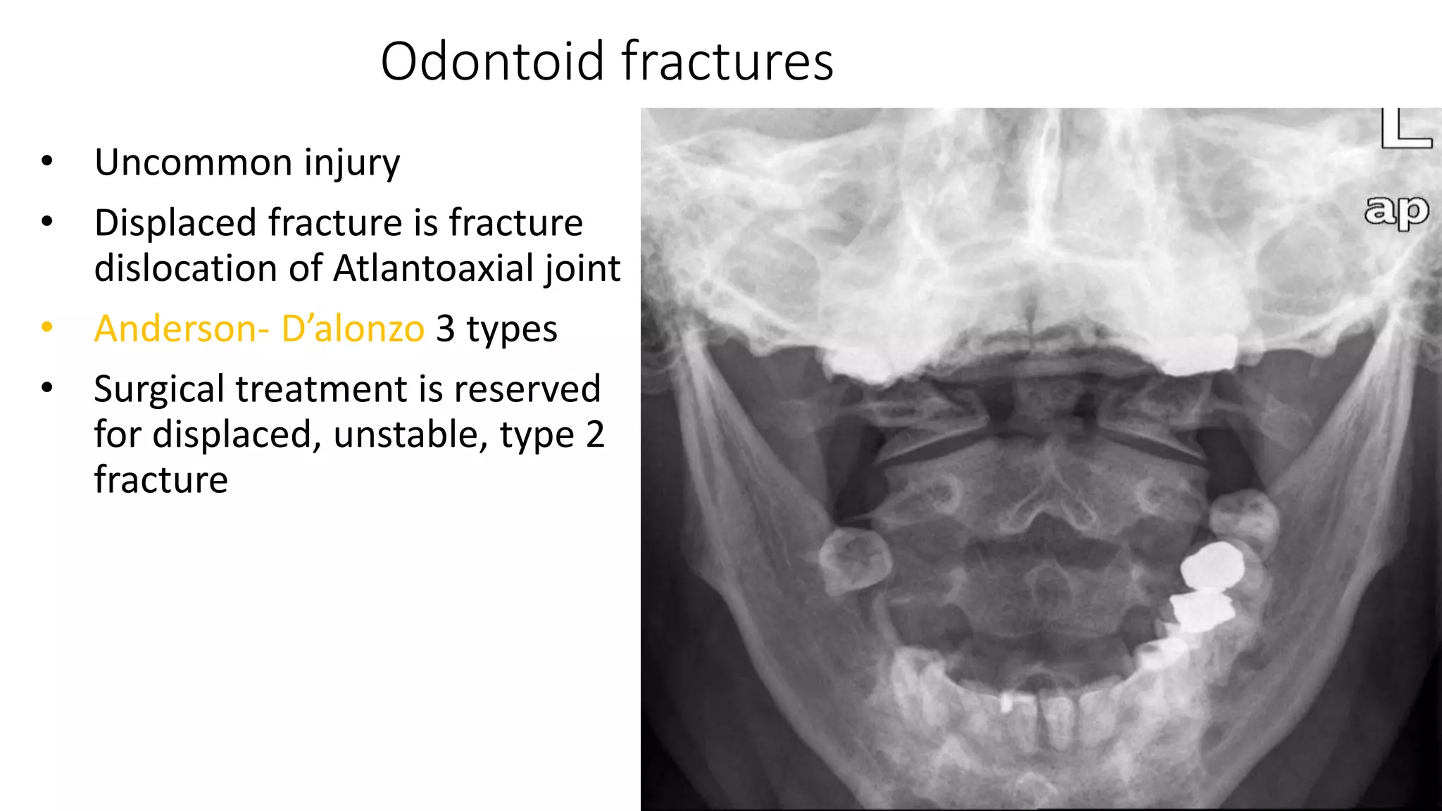 fractures & dislocation spine.pptx
