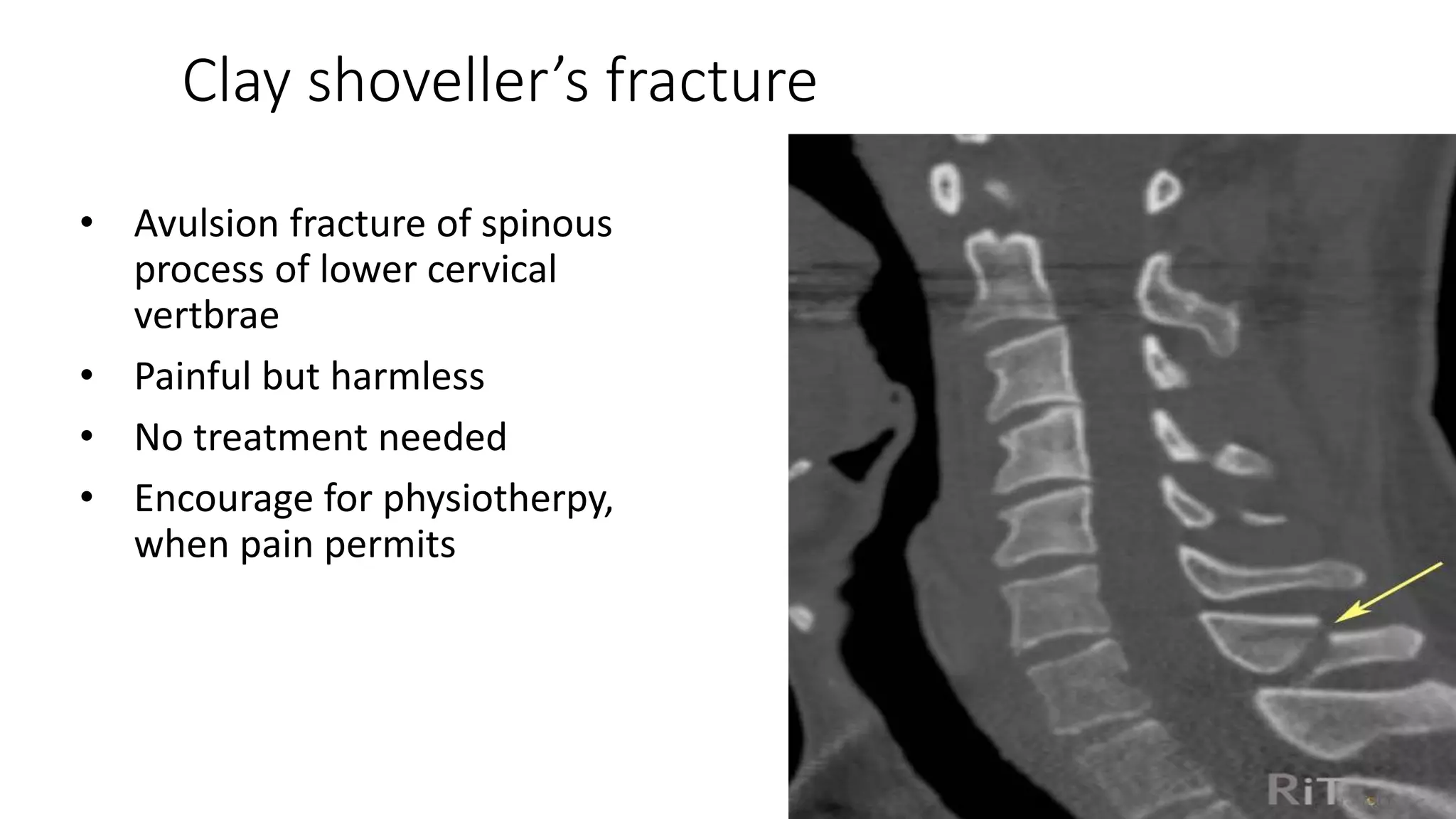 fractures & dislocation spine.pptx