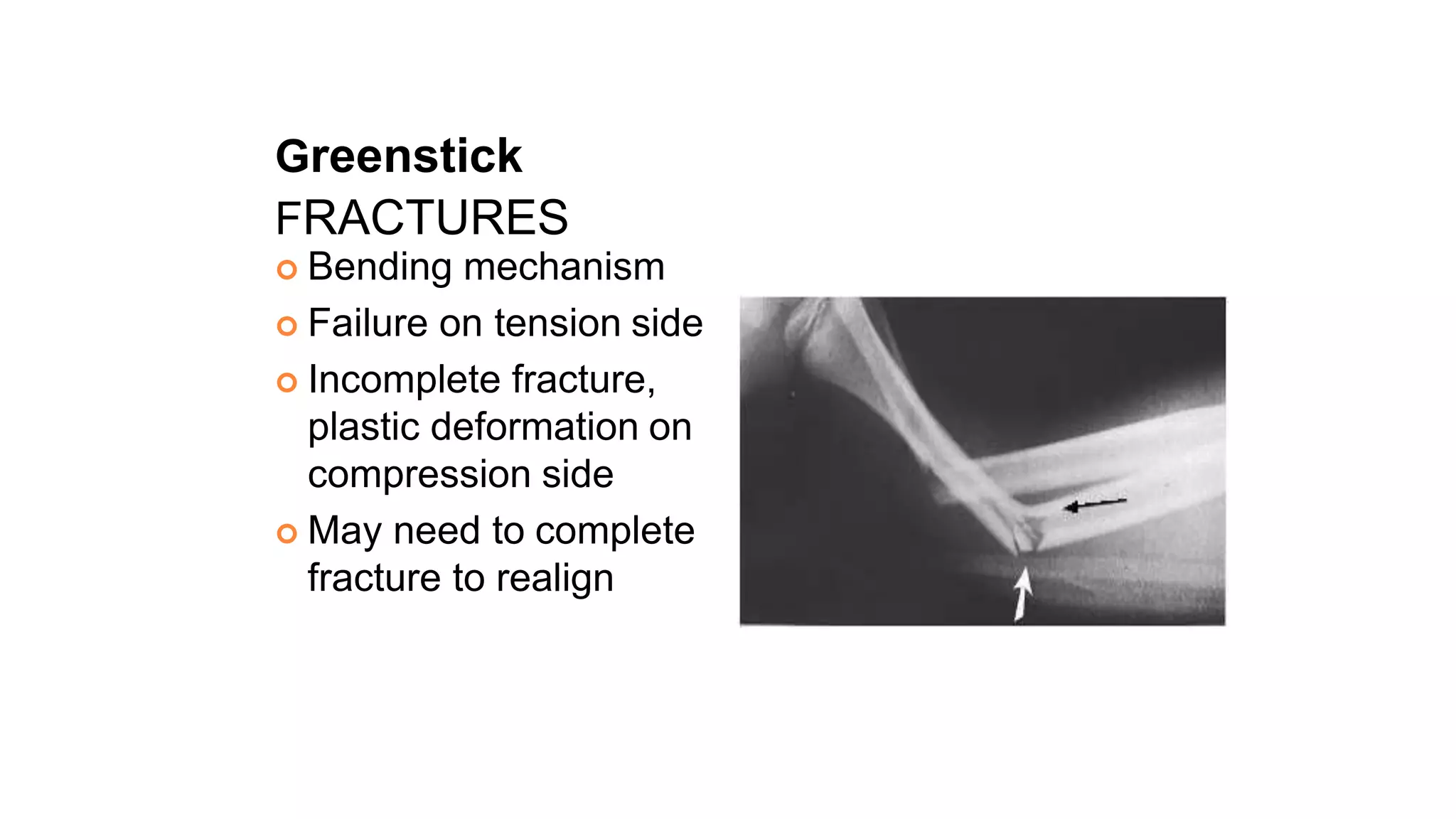 Fracture classification | PPTX