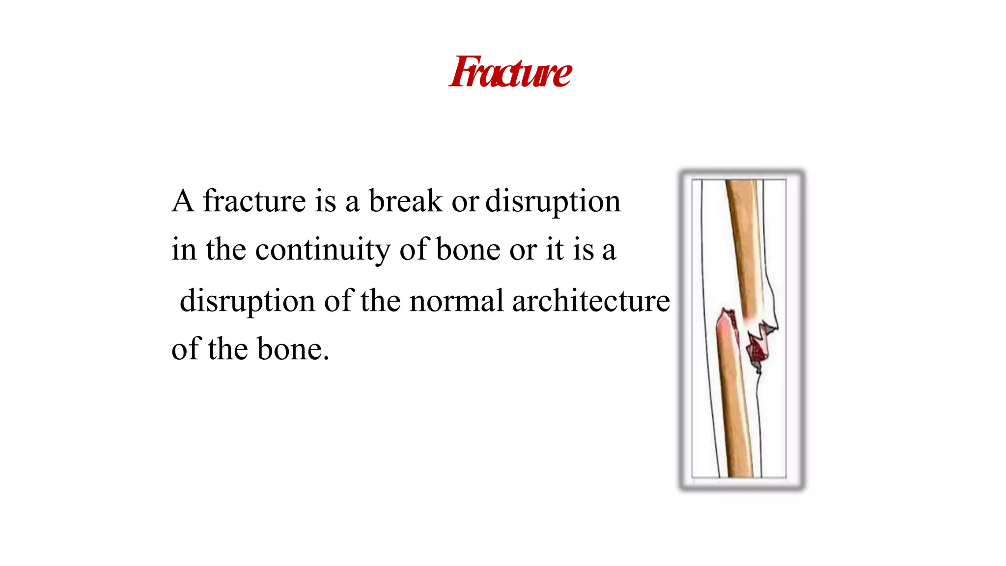 Fracture classification | PPT