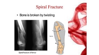 Fracture classification | PPTX