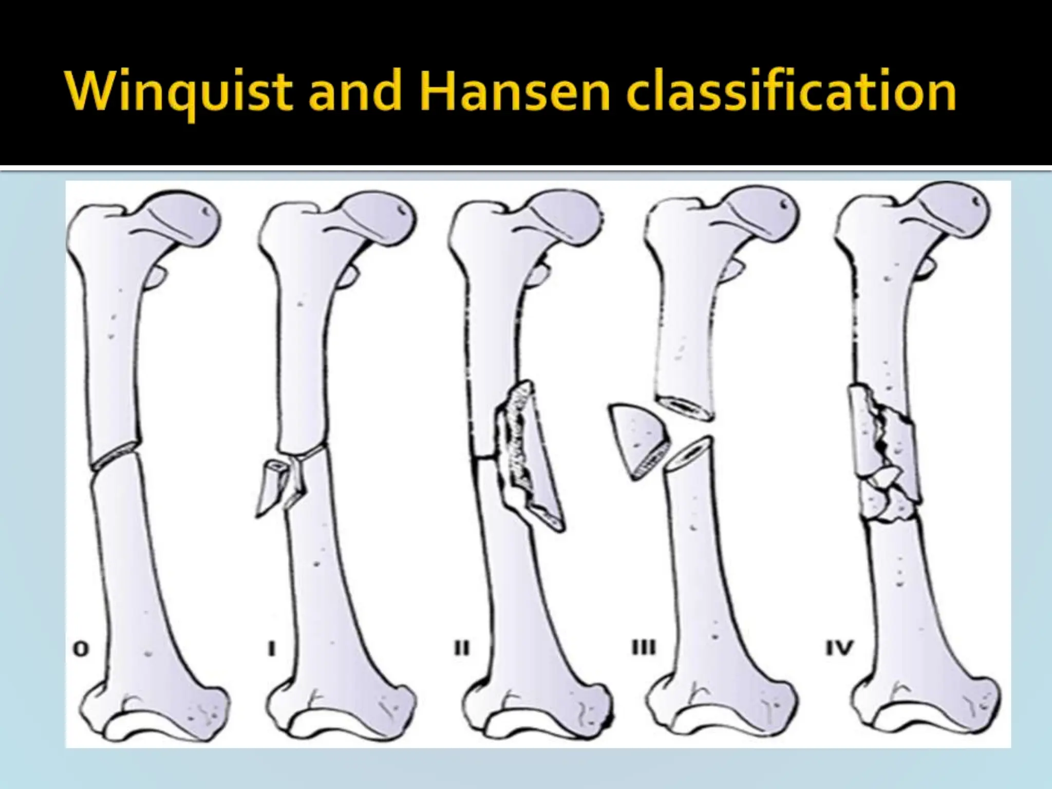 FRACTURE SHAFT FEMUR PPT by dr.bharti pawar.pptx