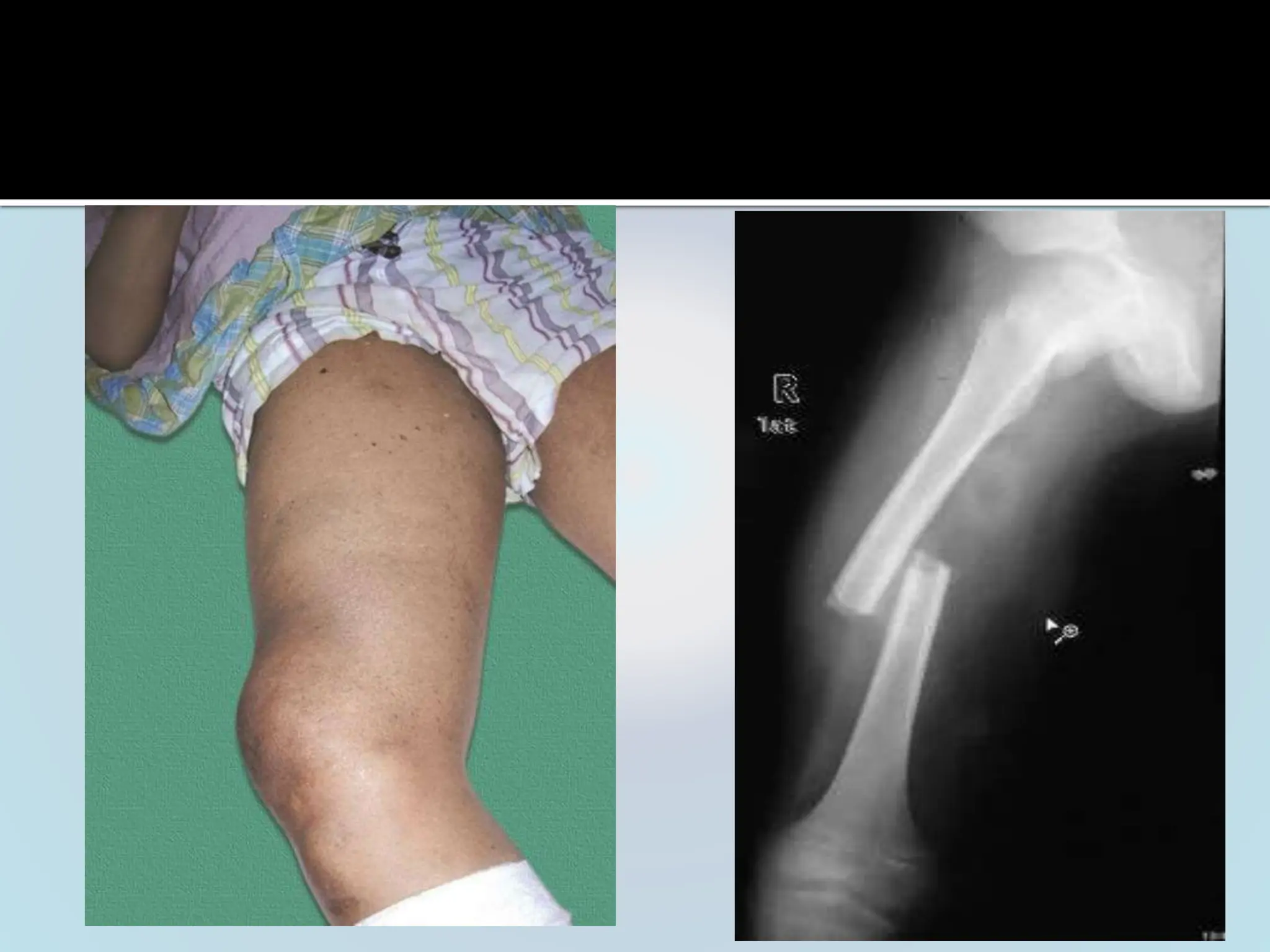 FRACTURE SHAFT FEMUR PPT by dr.bharti pawar.pptx