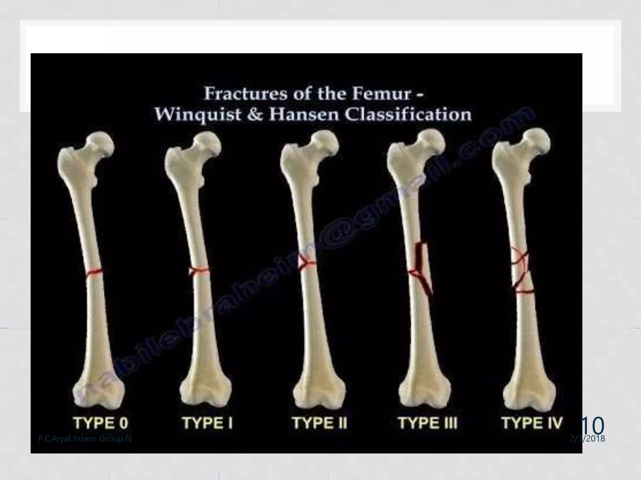 fracture shaft of femur.pptx