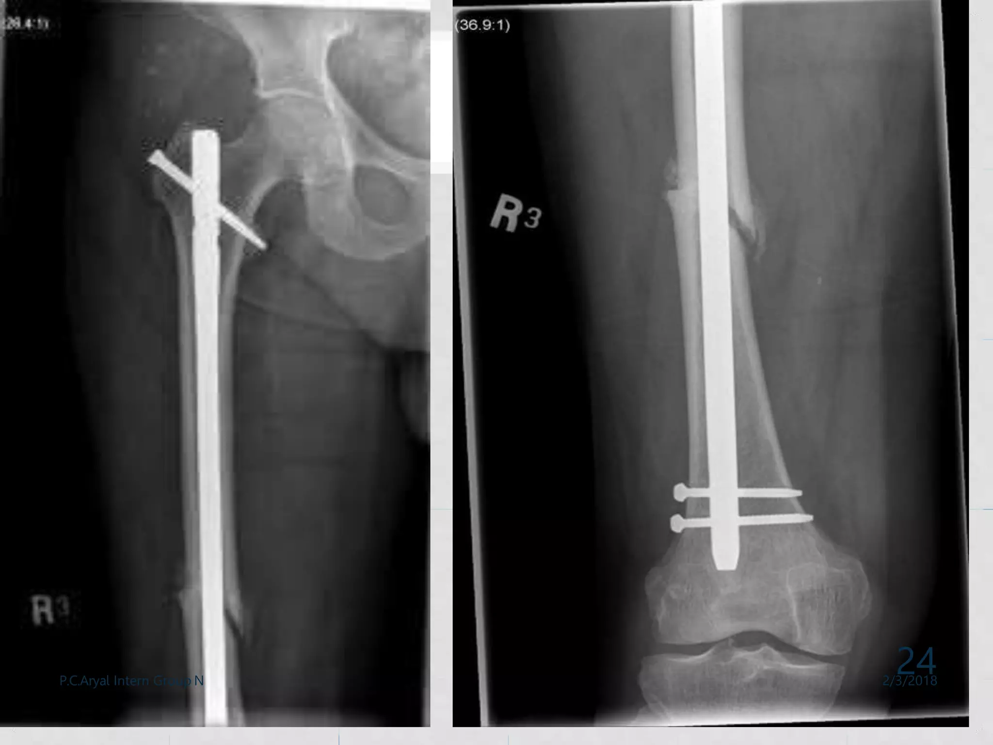 fracture shaft of femur.pptx