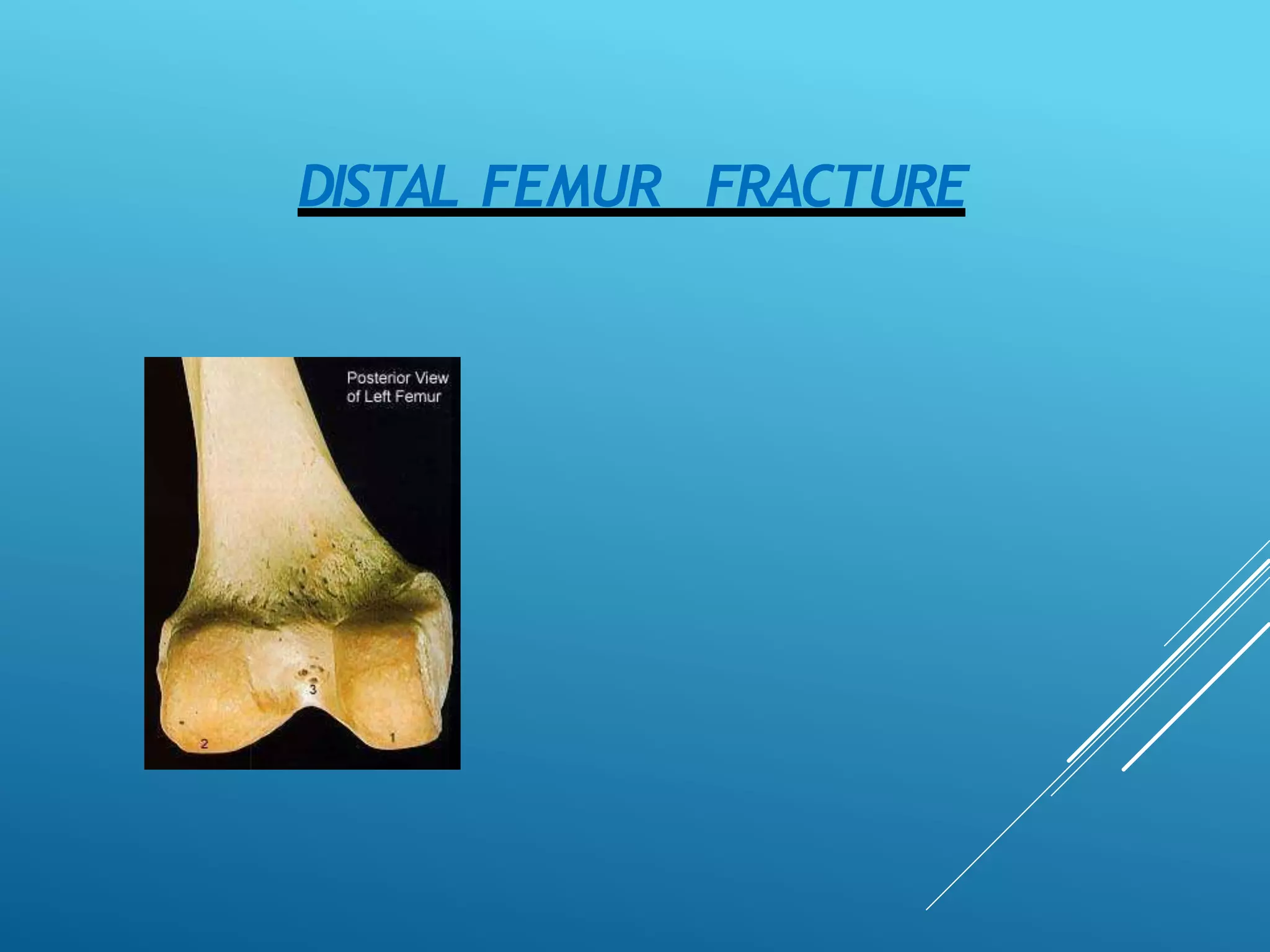 fracture shaft of femur.pptx | First Aid | Injuries