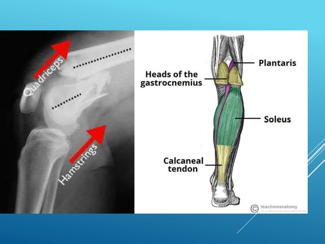 fracture shaft of femur.pptx | First Aid | Injuries