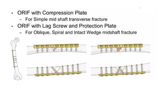 Fracture shaft of femur // Management.pptx