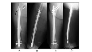 Fracture shaft of femur // Management.pptx
