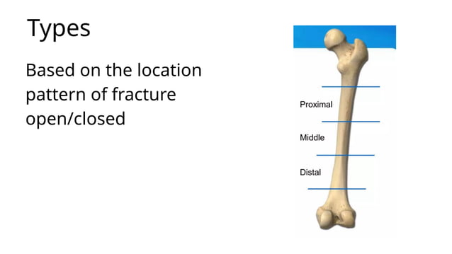 Fracture shaft of femur // Management.pptx