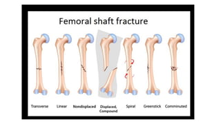 Fracture shaft of femur // Management.pptx