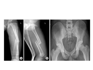 FRACTURE SHAFT OF FEMUR AND PATELLA FRACTURE MBBS UG Dr Rakesh Singha ...