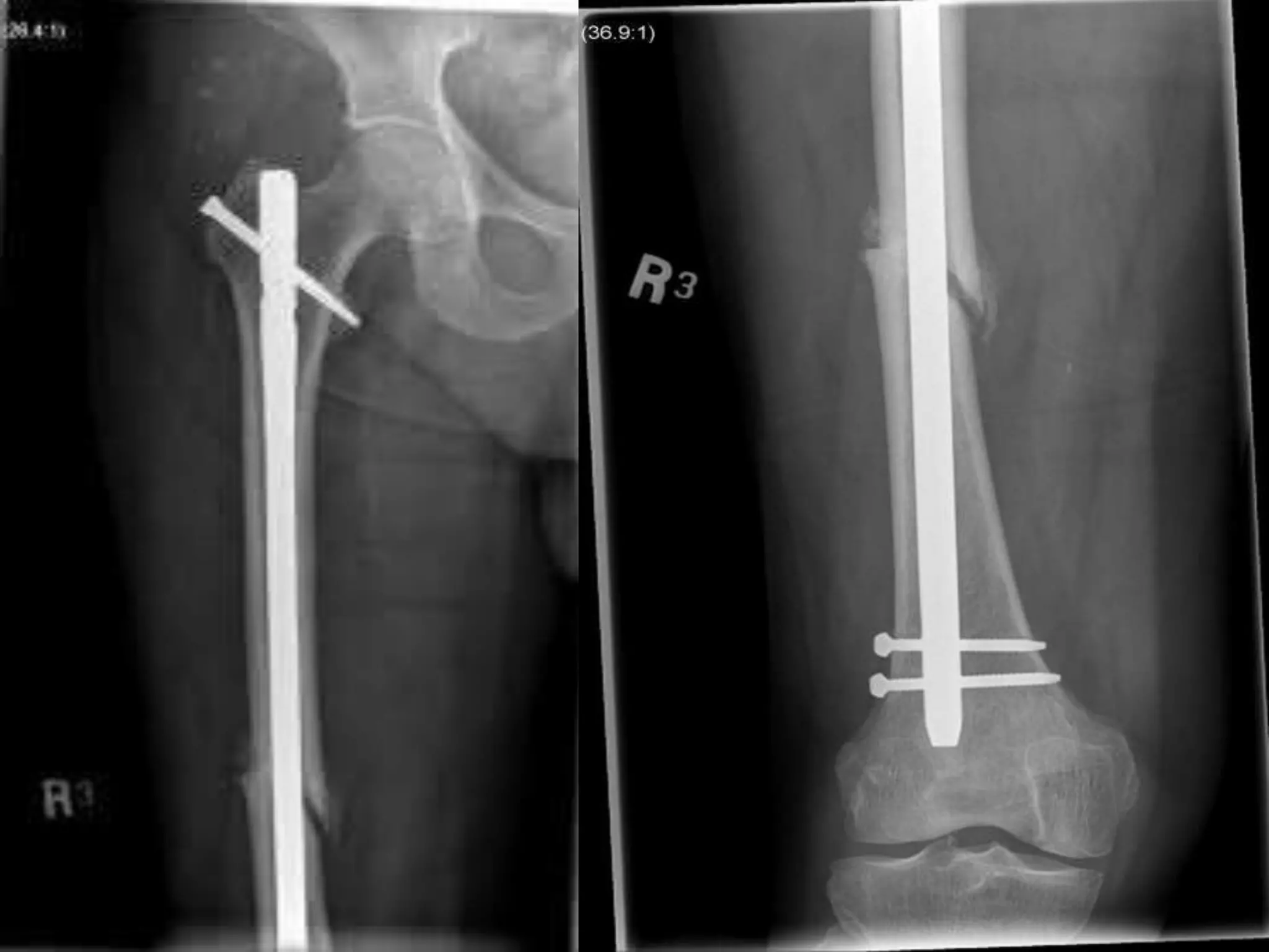 Fracture shaft of femur by dr ashutosh | PPT