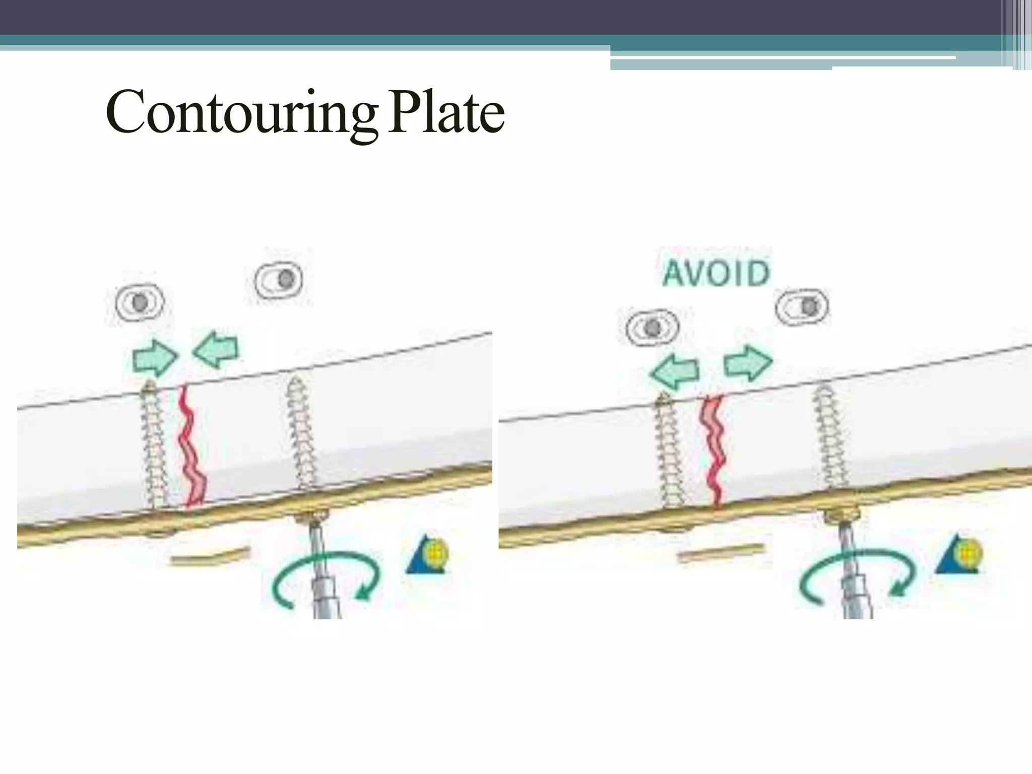 Fracture shaft of femur by dr ashutosh | PPT