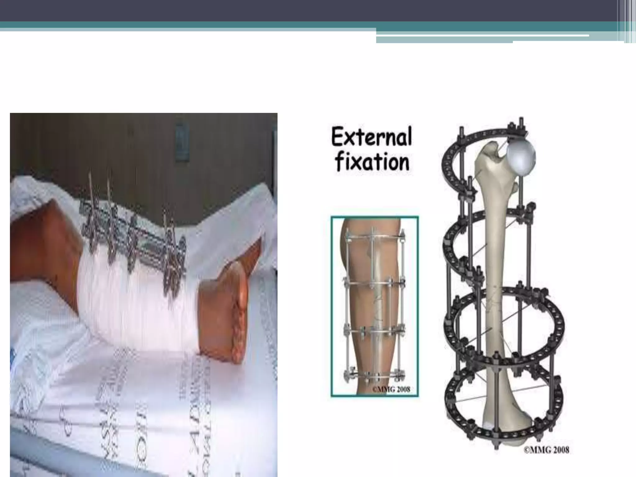 Fracture shaft of femur by dr ashutosh | PPT