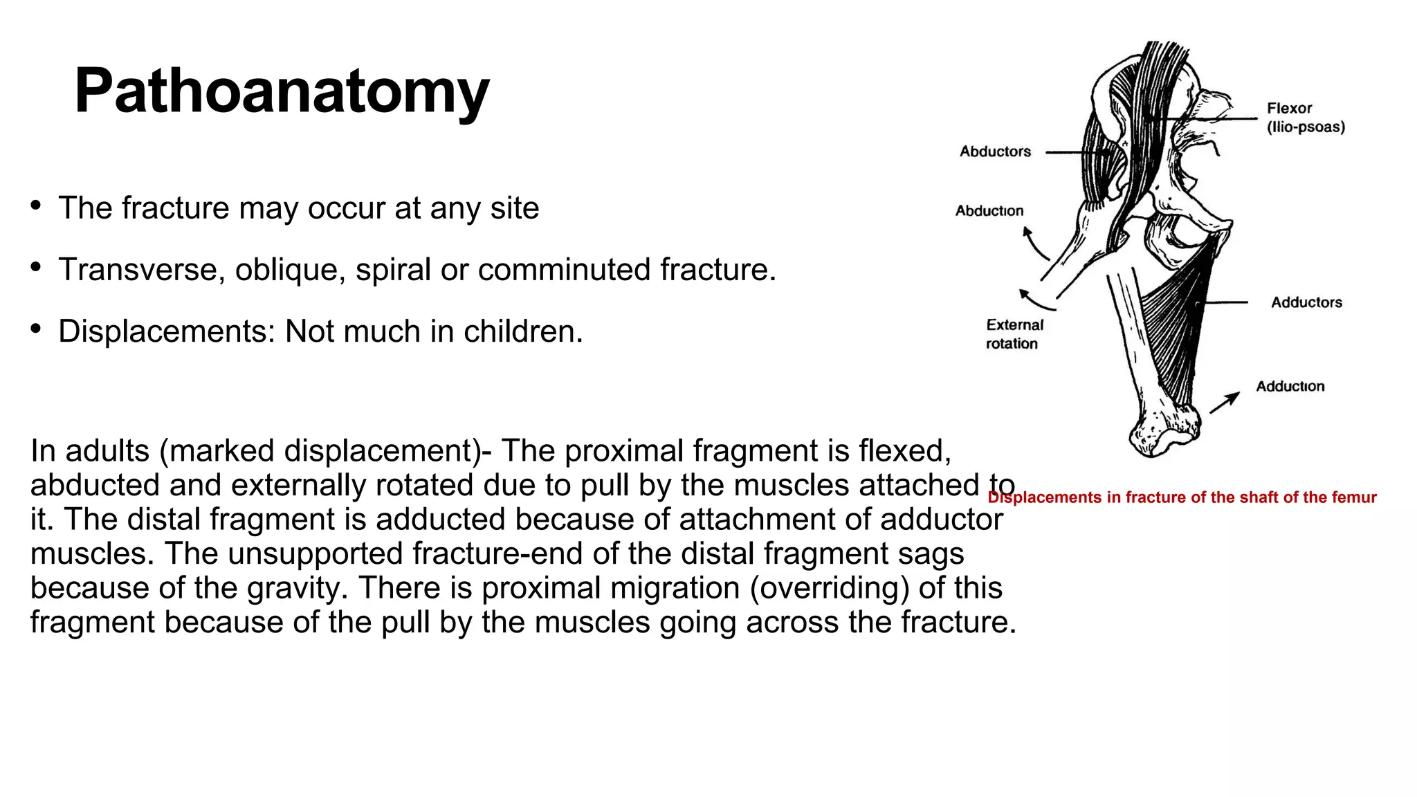 Fracture shaft of femur | PPTX