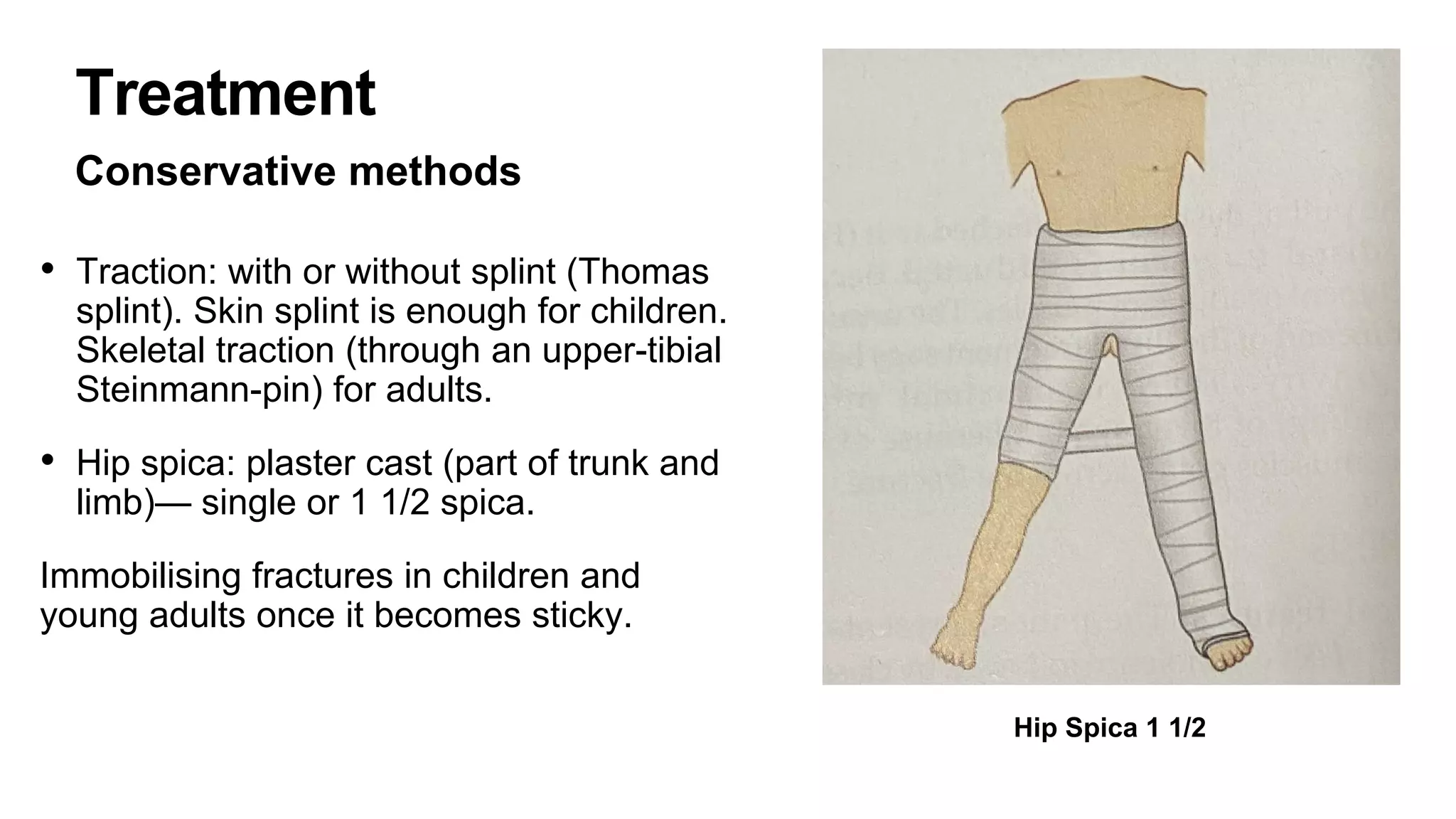Fracture shaft of femur | PPTX