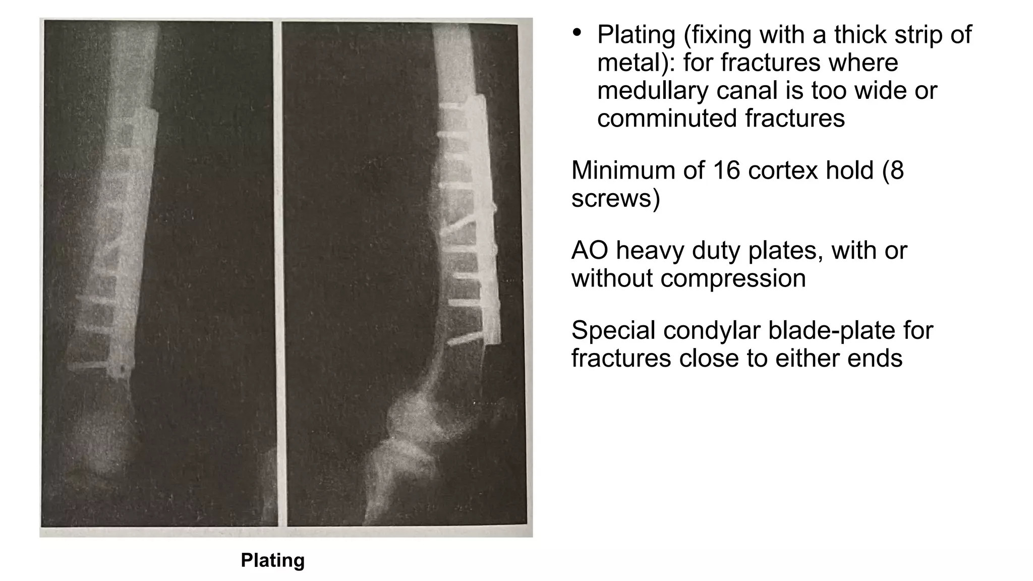 Fracture shaft of femur | PPTX