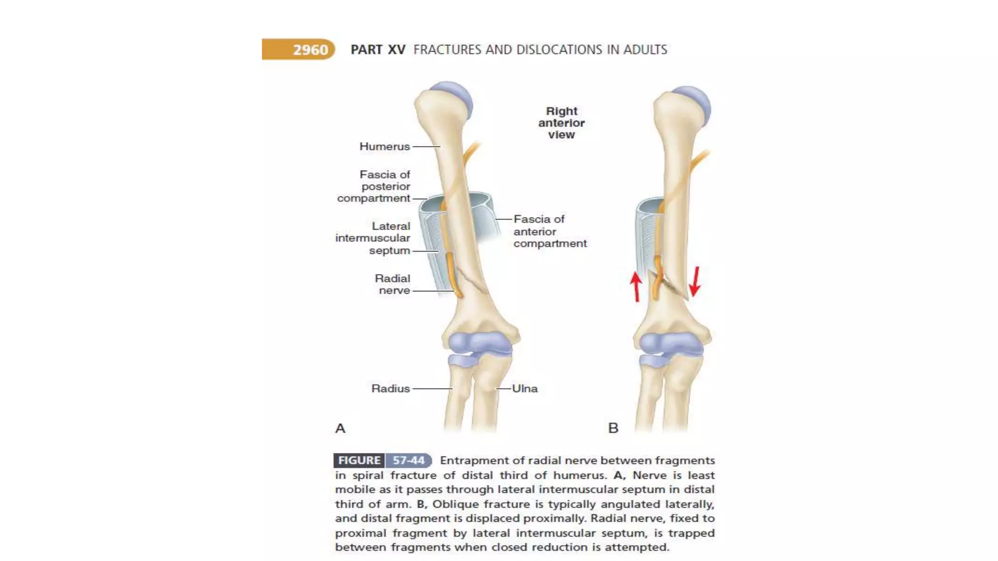 Fracture shaft of humerus | PPTX