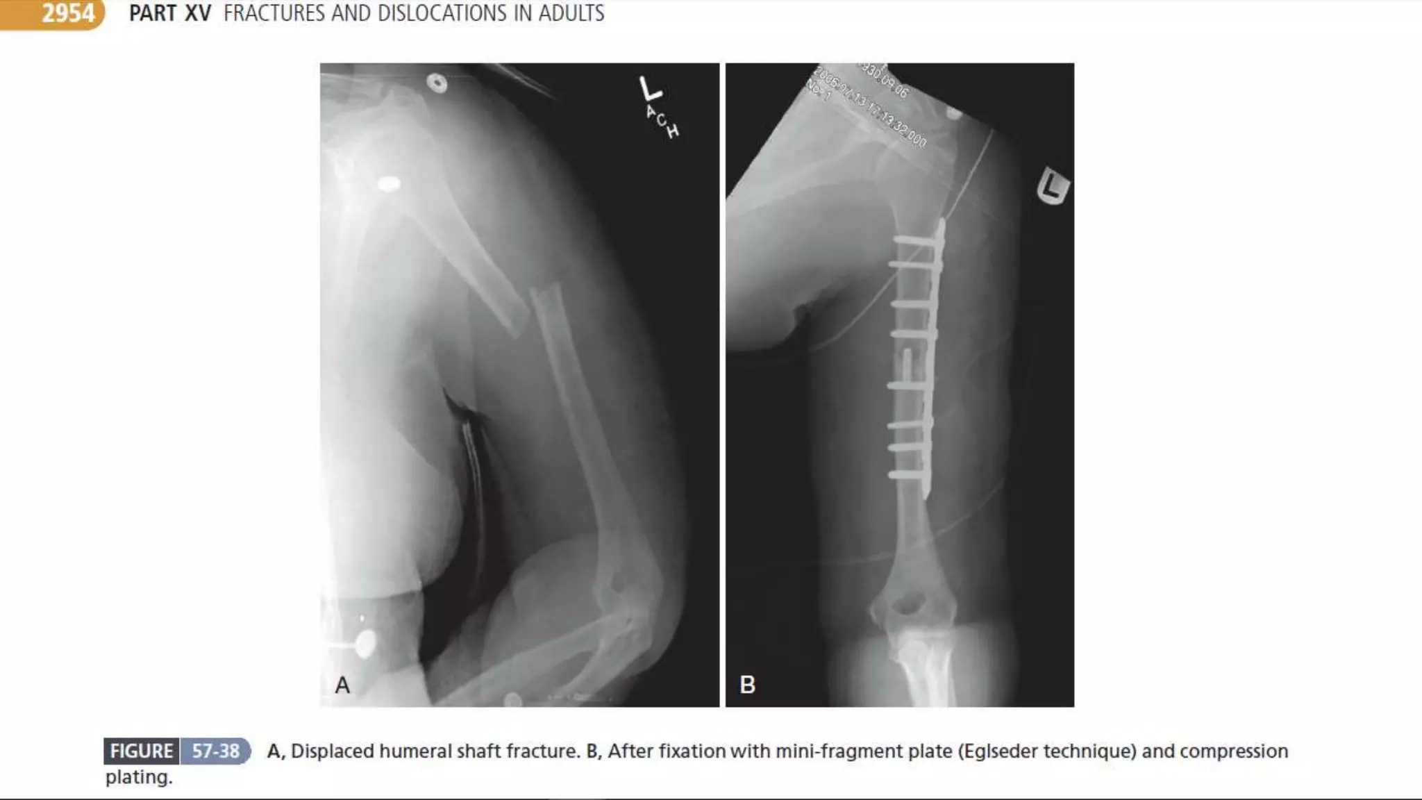 Fracture shaft of humerus | PPTX