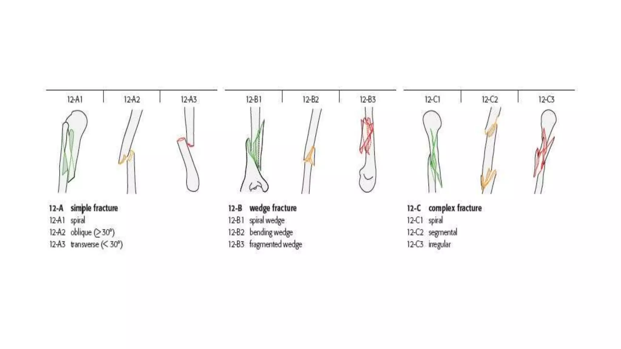 Fracture shaft of humerus | PPTX