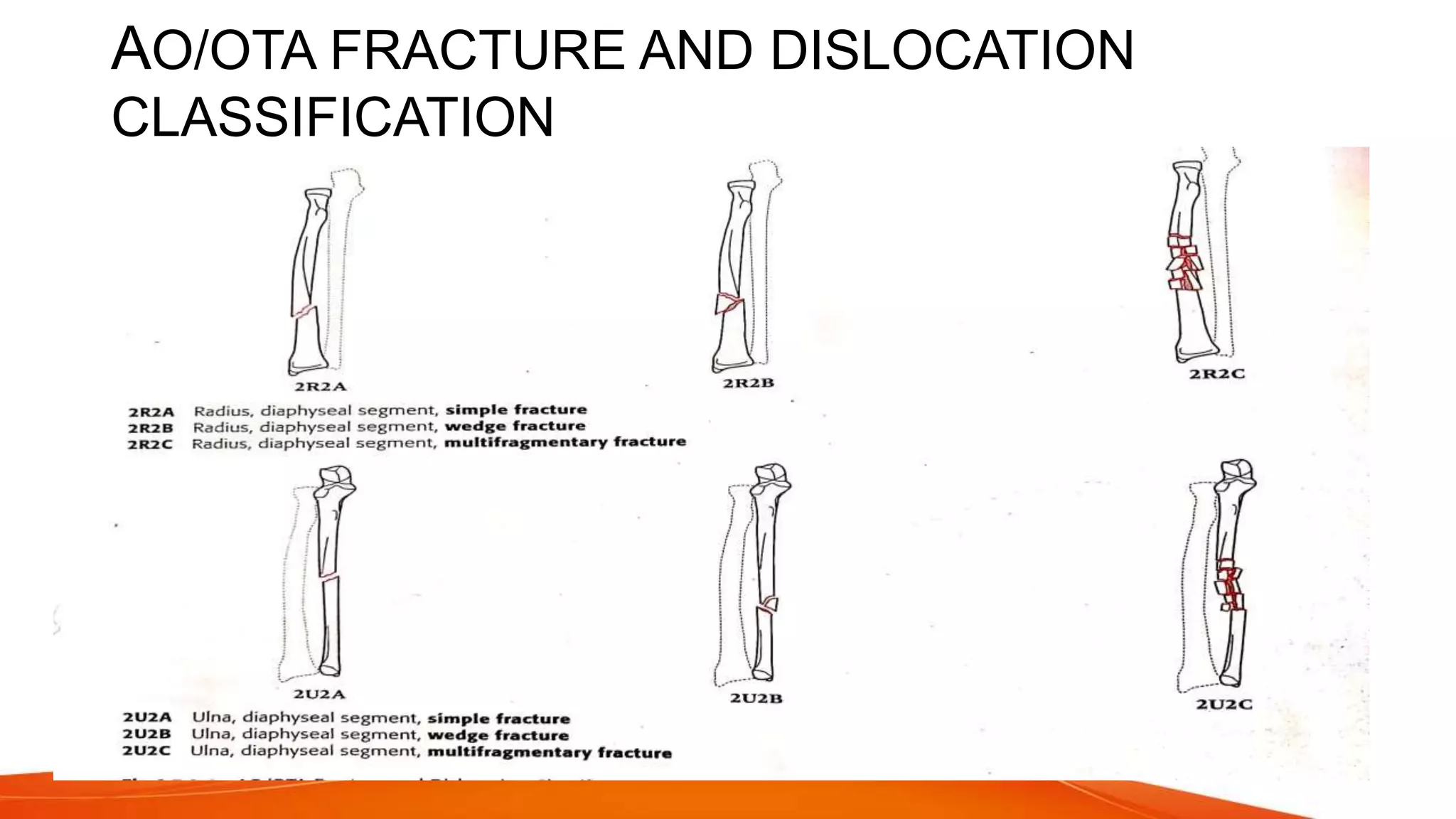 Fracture shaft of radius ulna 2021 | PPTX
