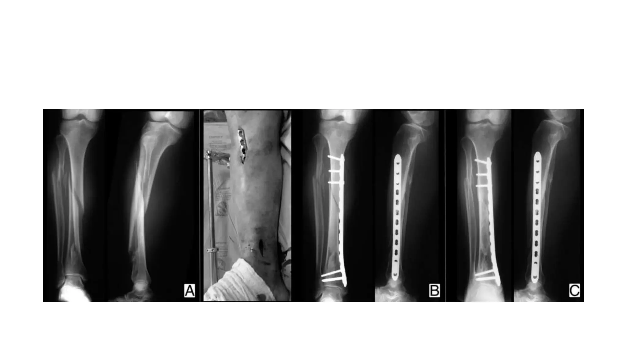 Fracture shaft of tibia | PPTX | Death, Injury, or Military Conflict ...