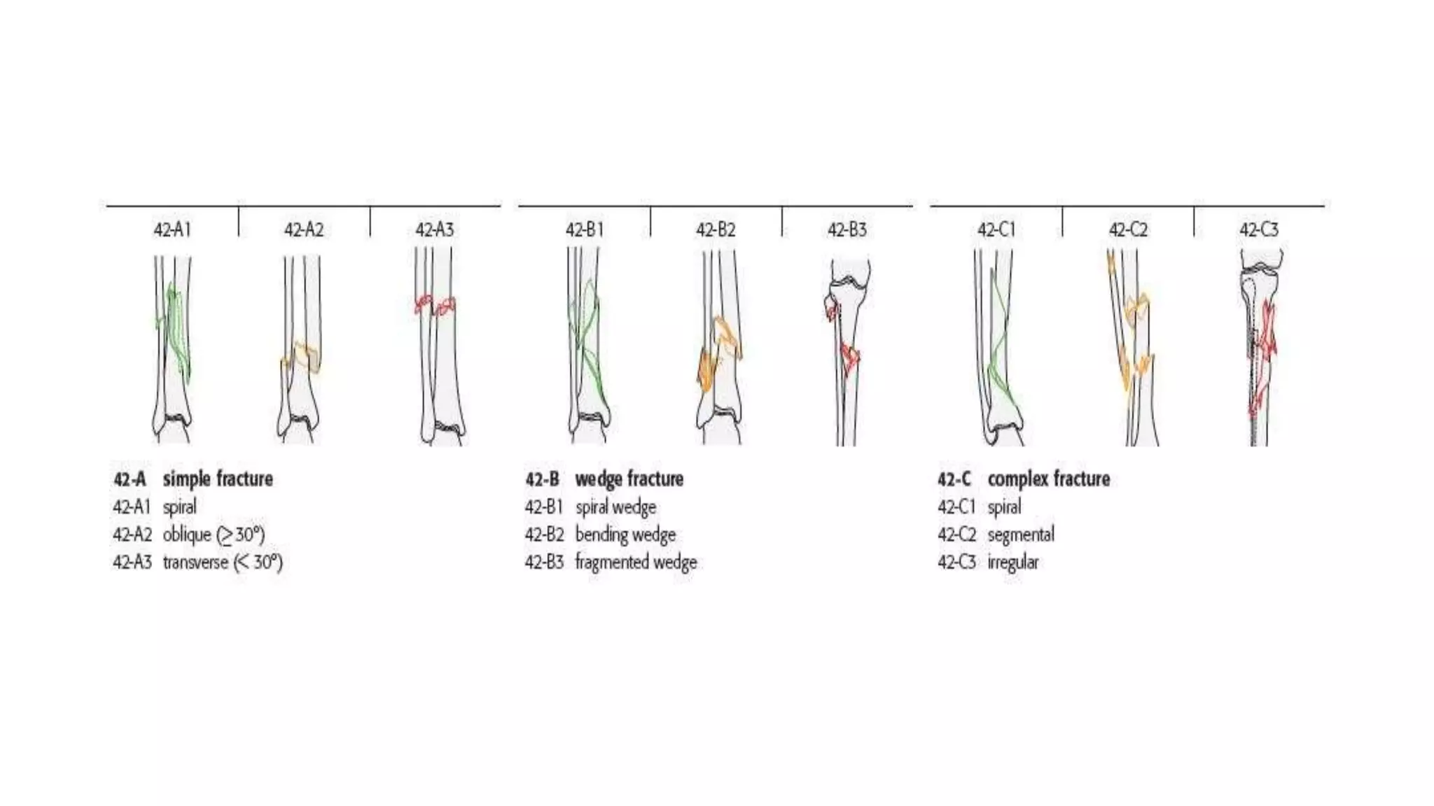 Fracture shaft of tibia | PPTX