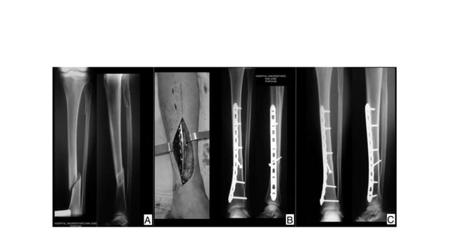 Fracture shaft of tibia | PPTX | Death, Injury, or Military Conflict ...