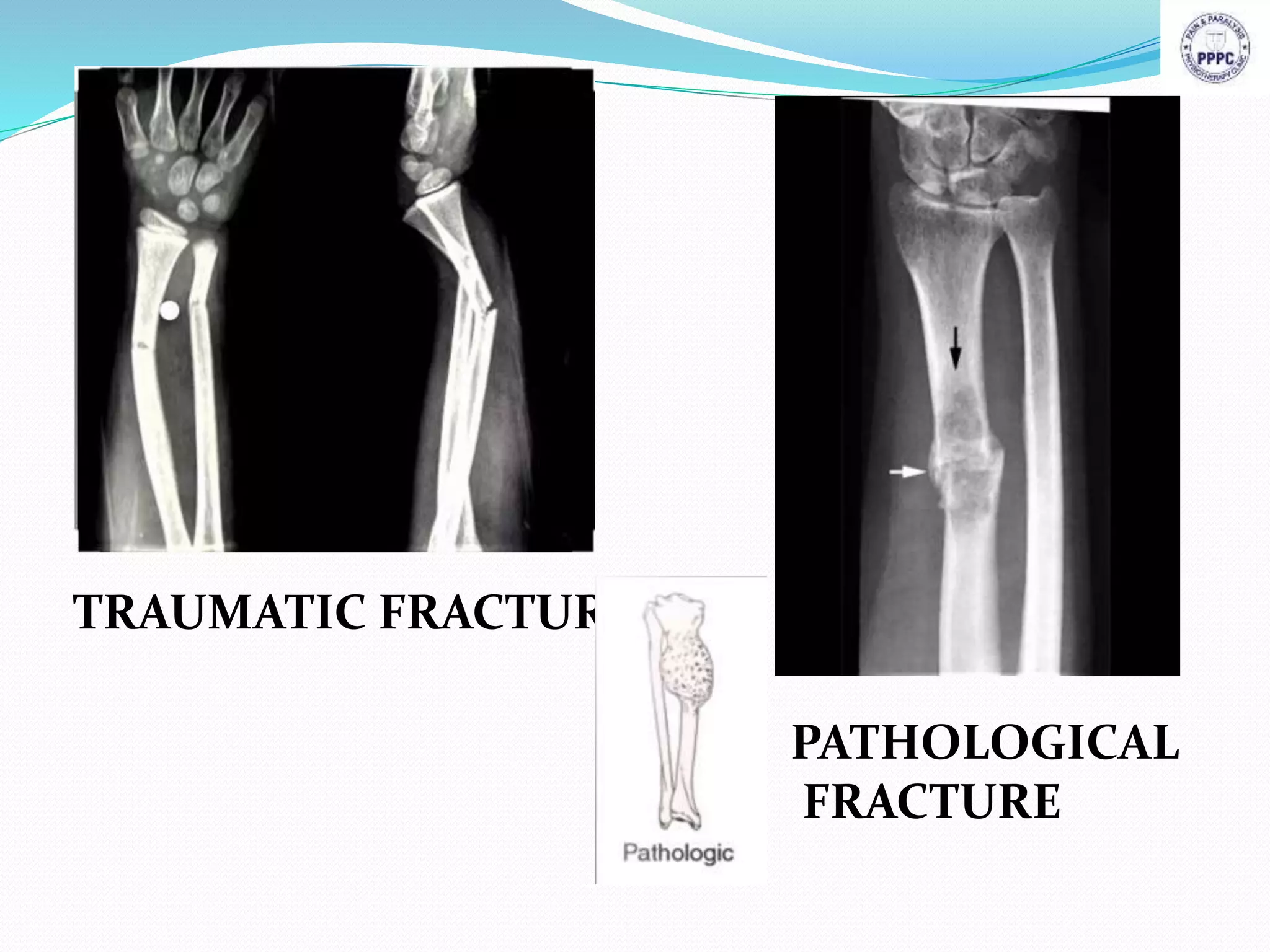 Fractures healing complication & management | PPTX