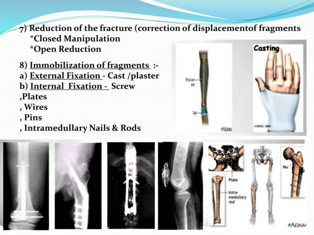 Fractures healing complication & management | PPTX