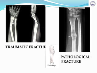 Fractures healing complication & management | PPTX | Death, Injury, or ...