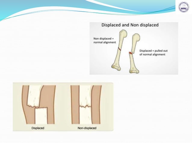 Fractures healing complication & management | PPTX