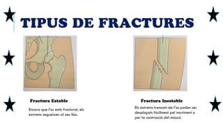 Fractures i luxacions | PPT