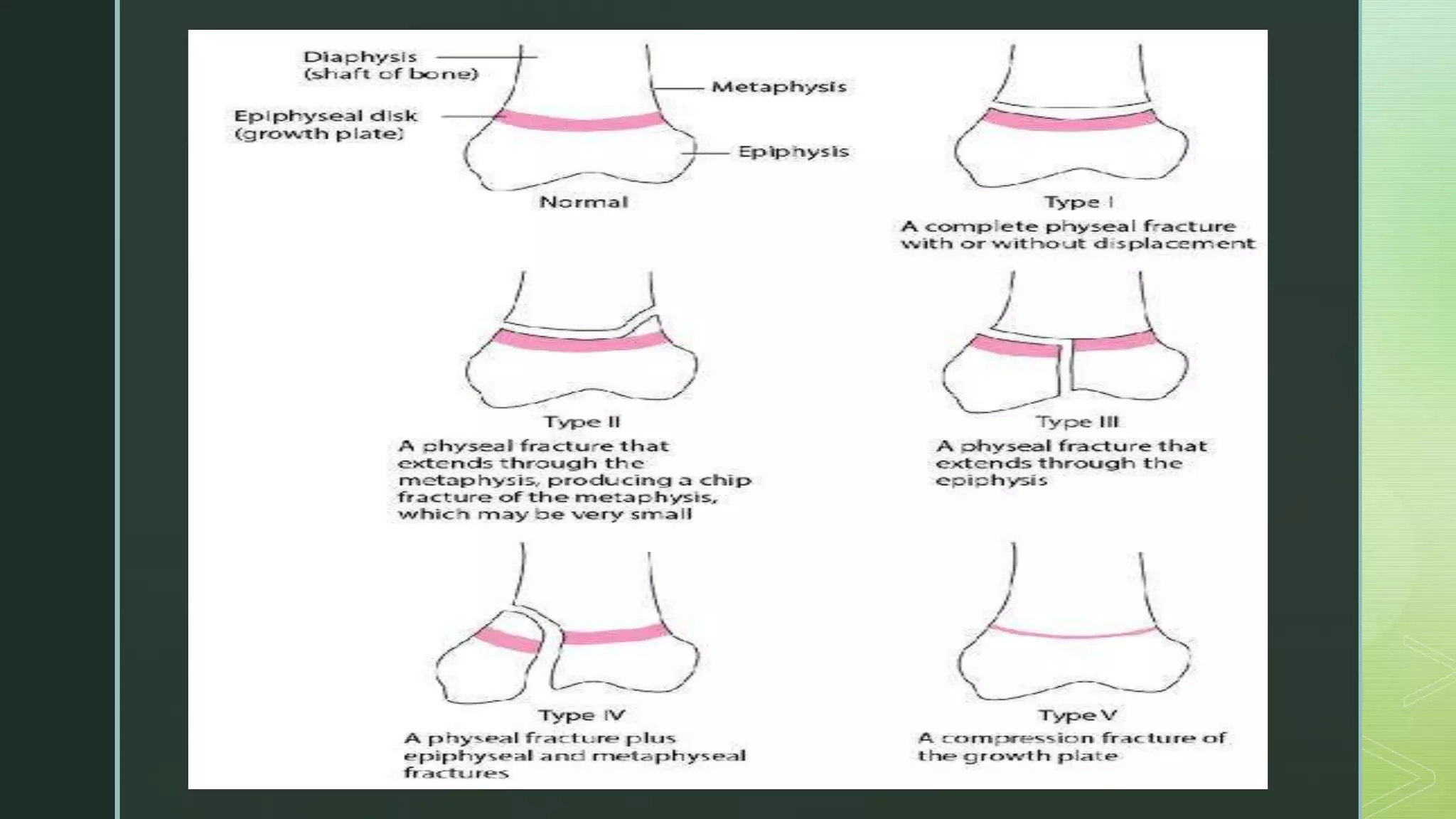 Fractures in Paediatric Age Group.pptx
