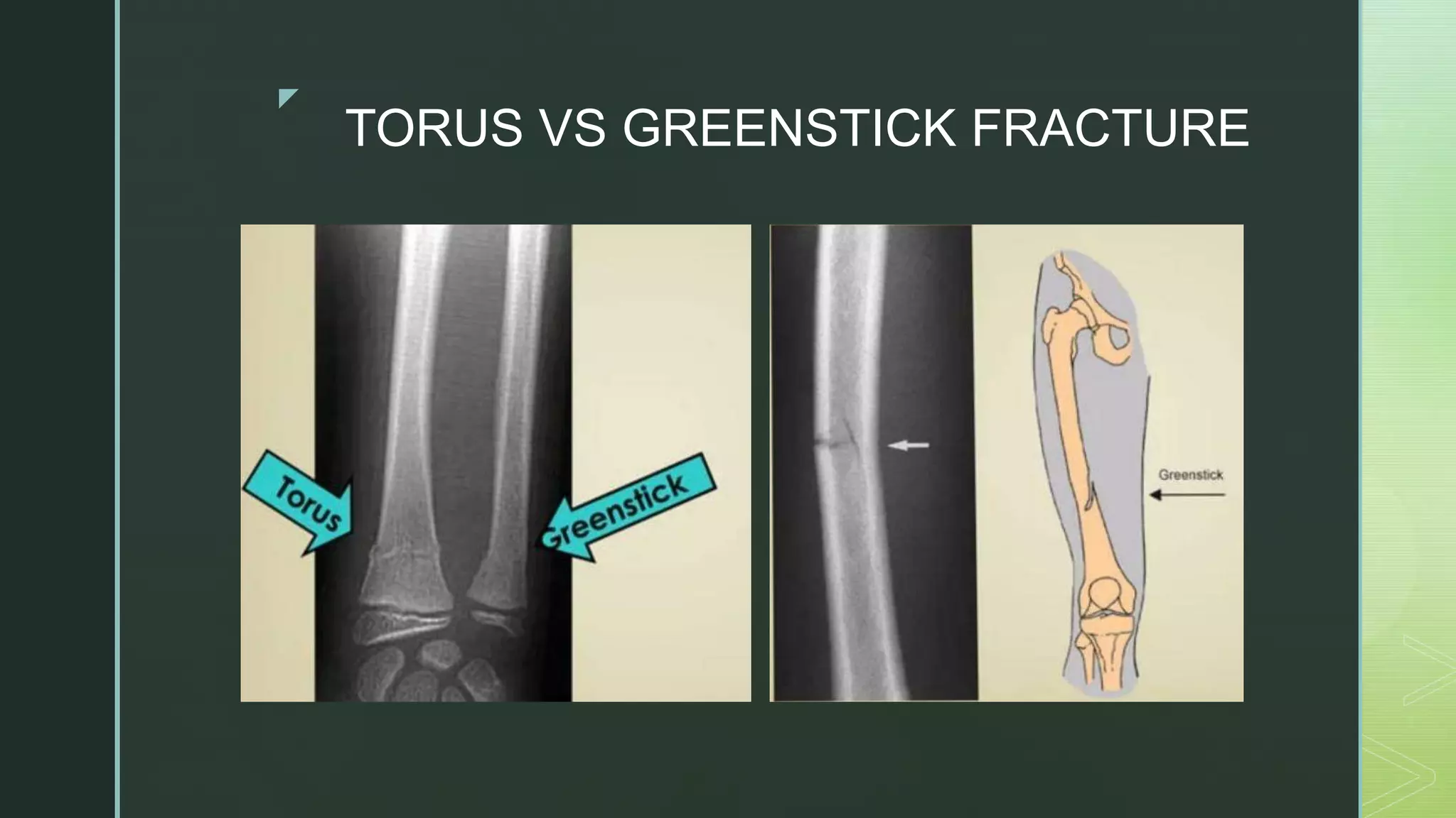 Fractures in Paediatric Age Group.pptx