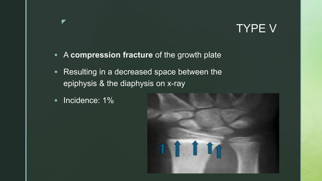 Fractures in Paediatric Age Group.pptx