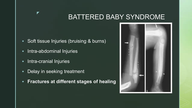 Fractures in Paediatric Age Group.pptx
