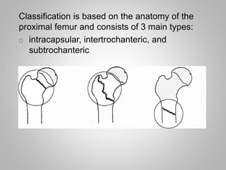 FRACTURE (Sites) | PPTX