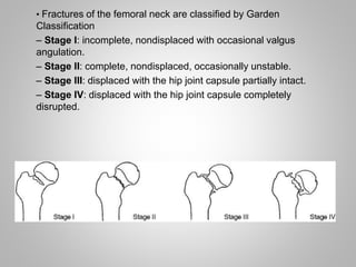 FRACTURE (Sites) | PPTX