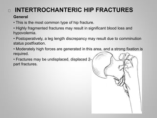 FRACTURE (Sites) | PPTX