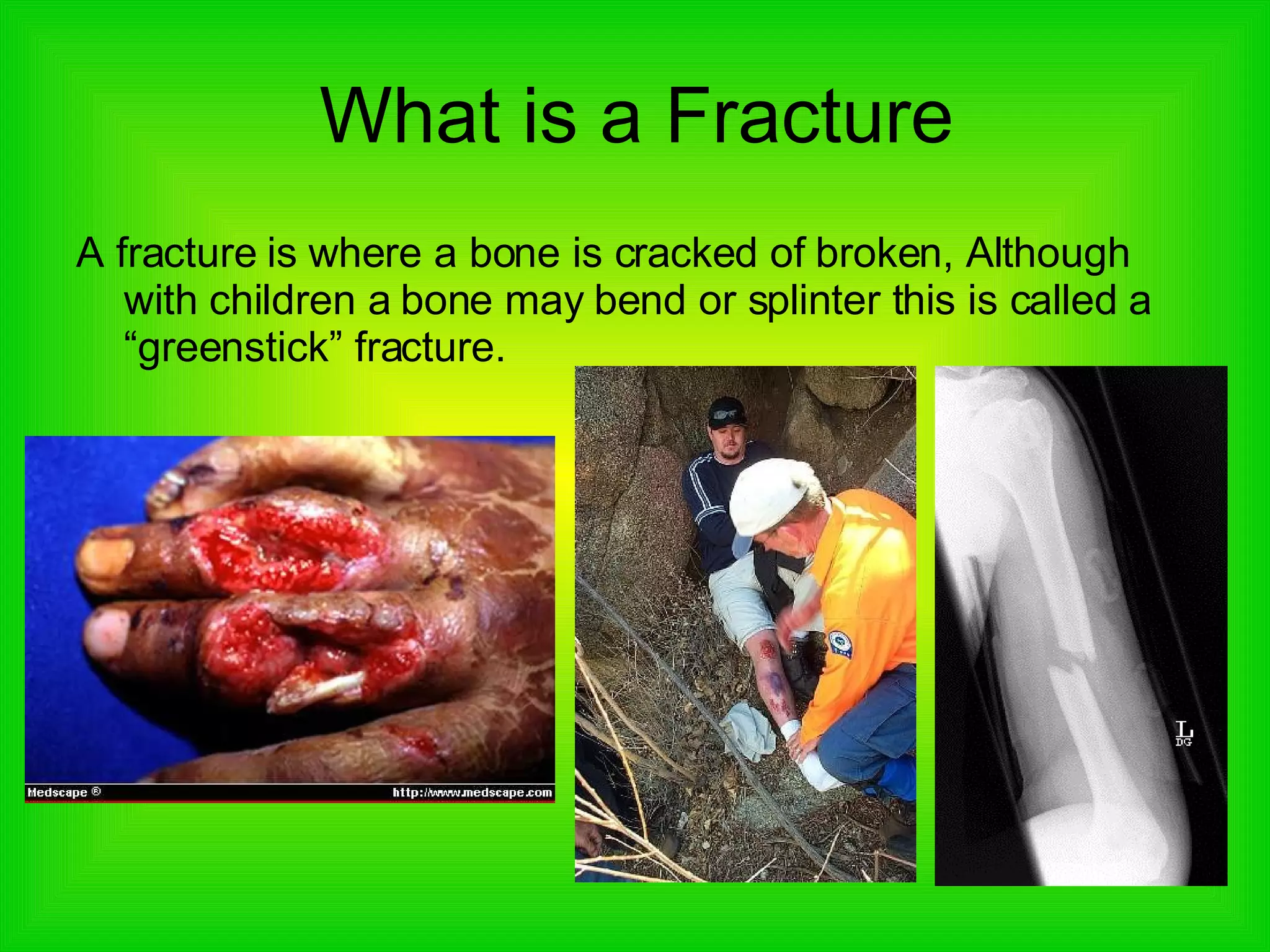 Fractures | PPT | First Aid | Injuries