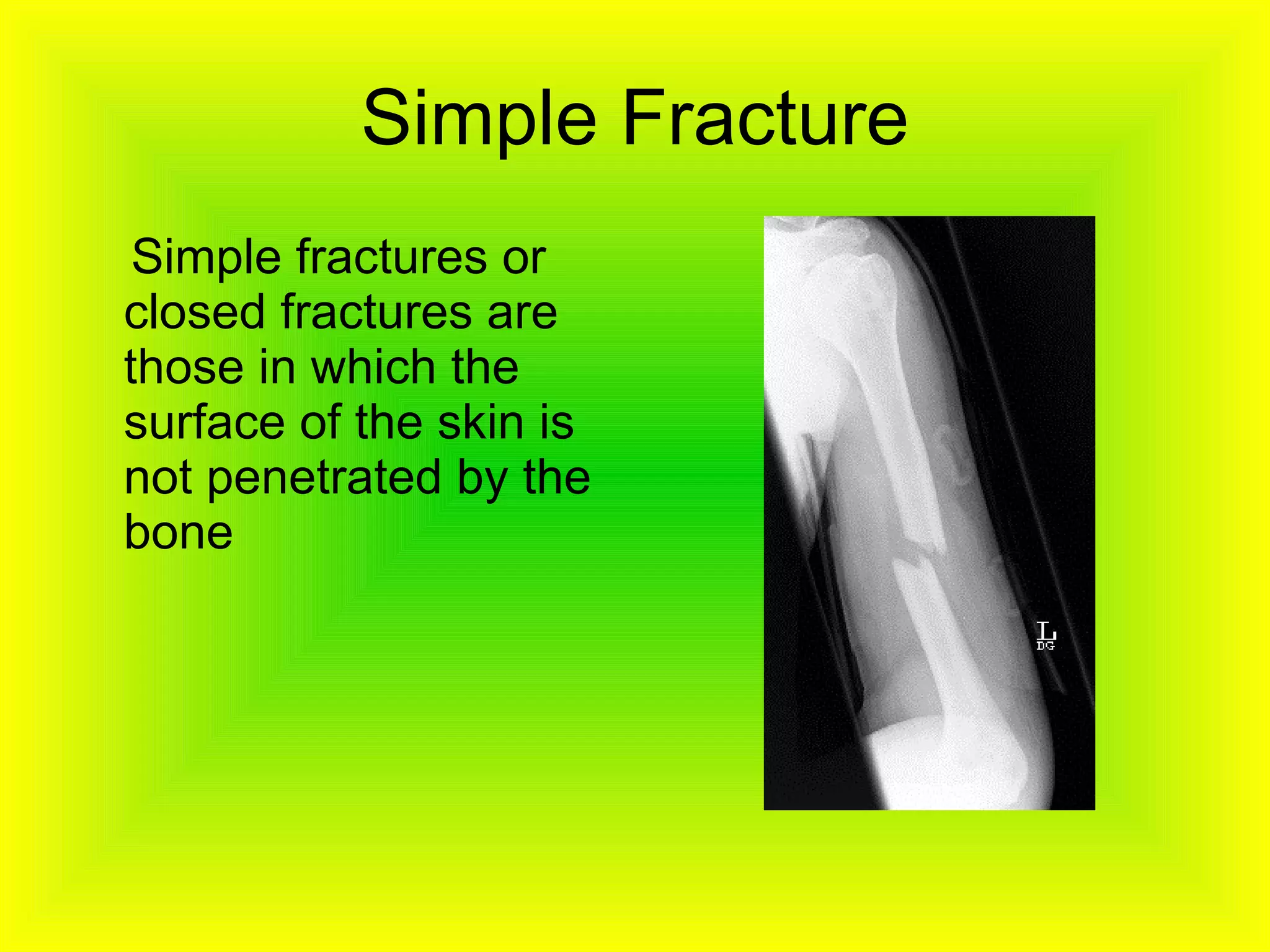 Fractures | PPT | First Aid | Injuries