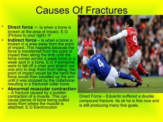 Fractures | PPT | First Aid | Injuries