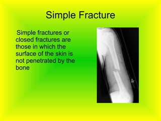 Fractures | PPT | First Aid | Injuries
