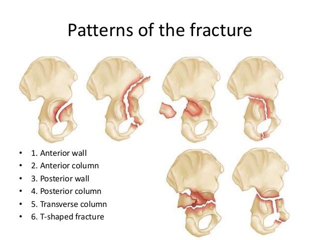 Fractures of acetabulum