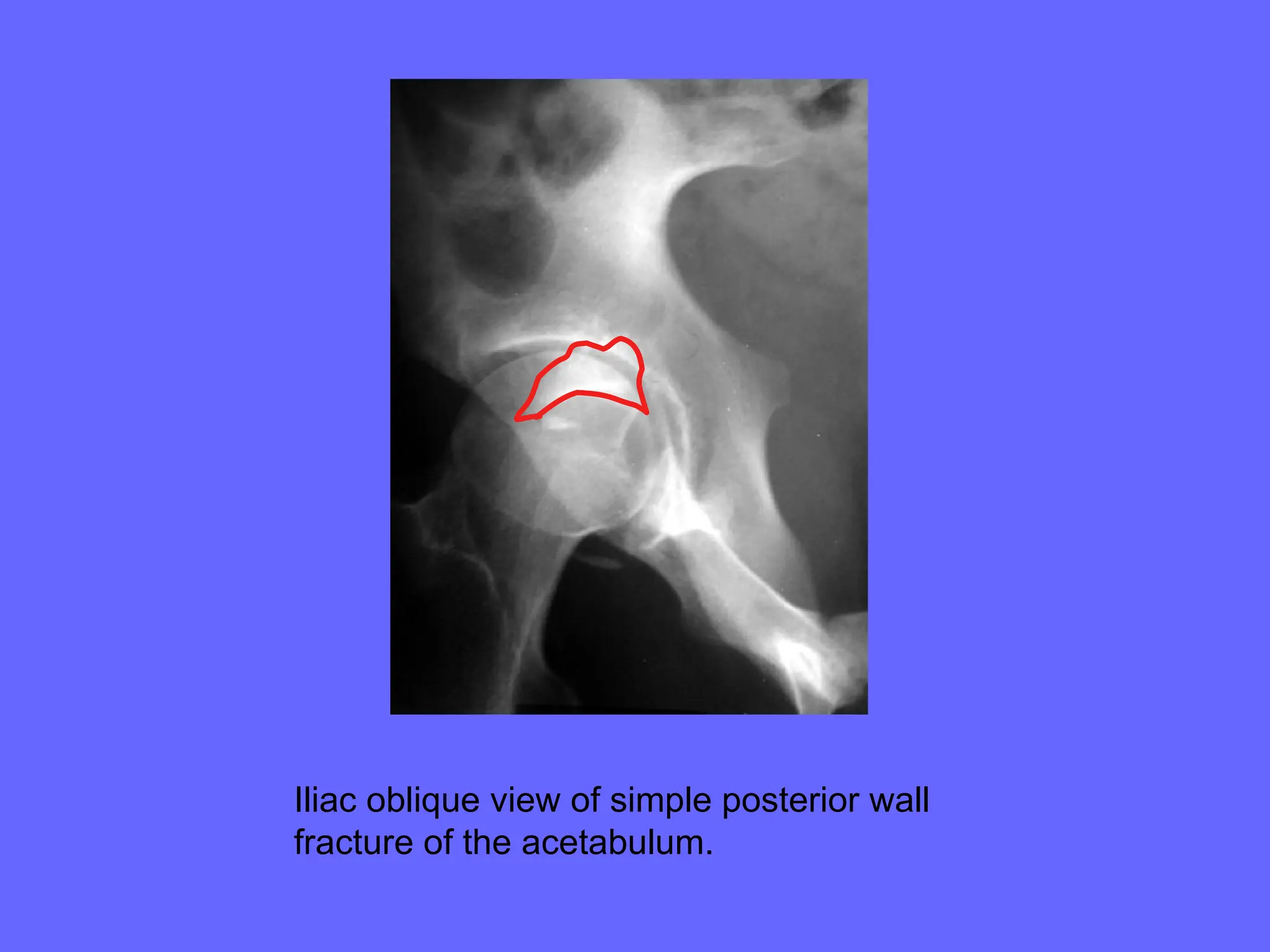 FRACTURES OF ACETABULUM.ppt fractures around hip | PPT
