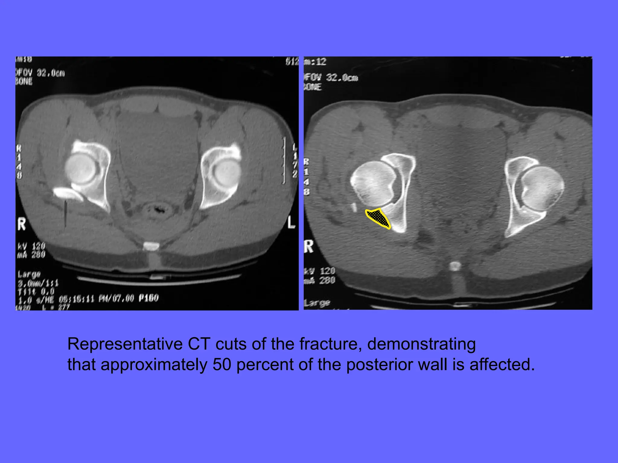 FRACTURES OF ACETABULUM.ppt fractures around hip | PPT