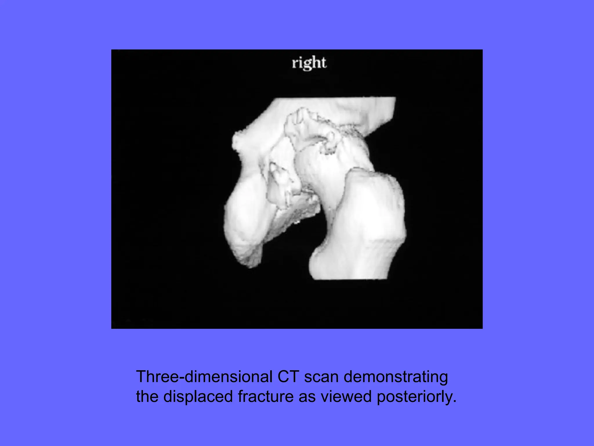 FRACTURES OF ACETABULUM.ppt fractures around hip | PPT