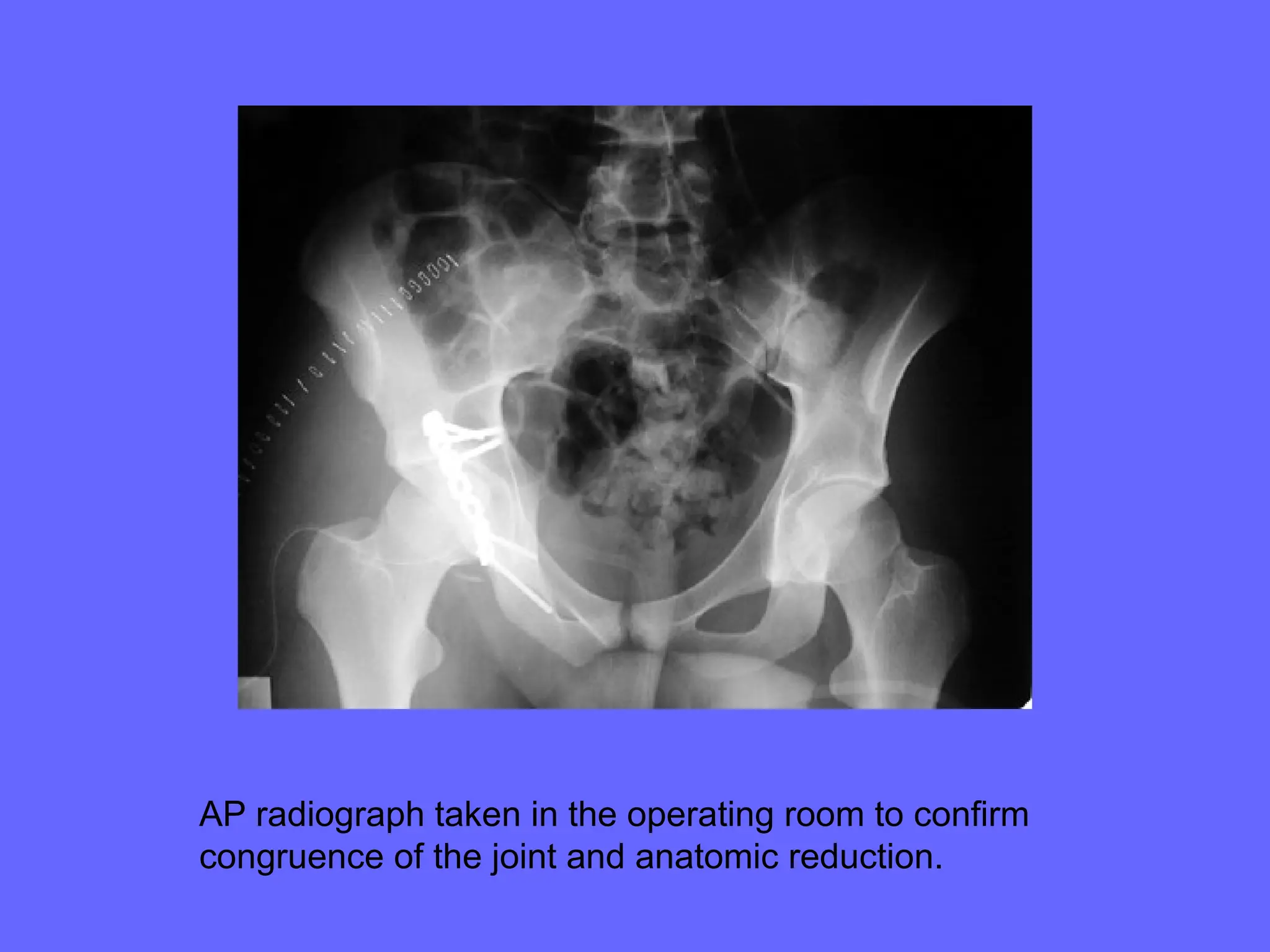 FRACTURES OF ACETABULUM.ppt fractures around hip | PPT